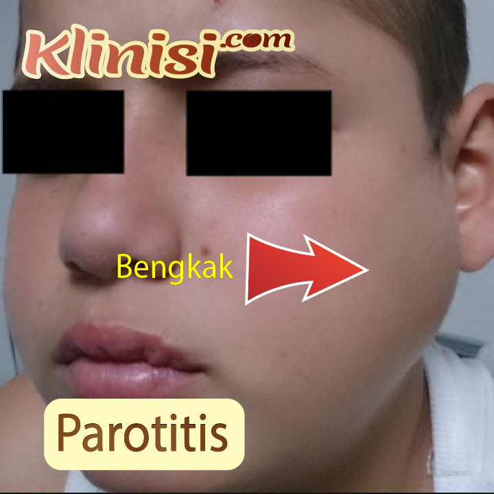 Parotitis / Penyakit Digestive