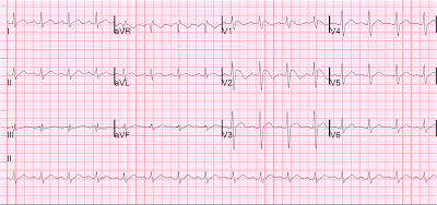 Dr. Smith's ECG Blog: Brugada pattern induced by tricyclic antidepressant