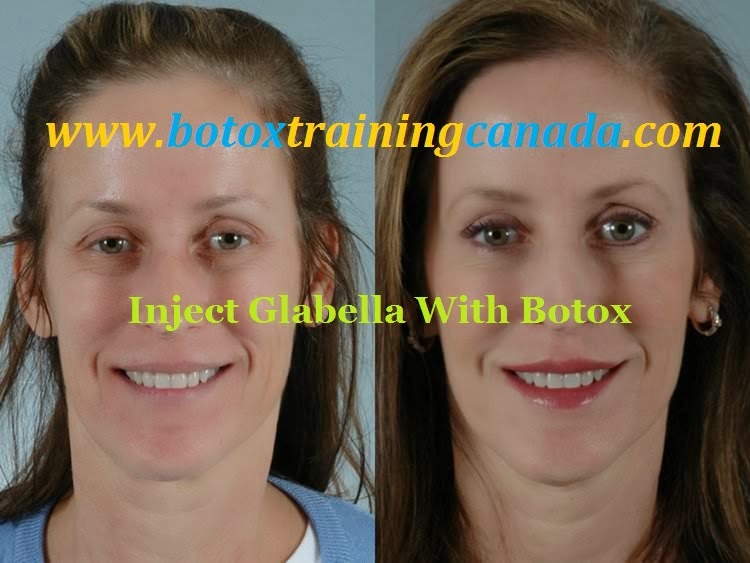 Botox Training Canada: Best Advice For How to Inject Glabella With Botox