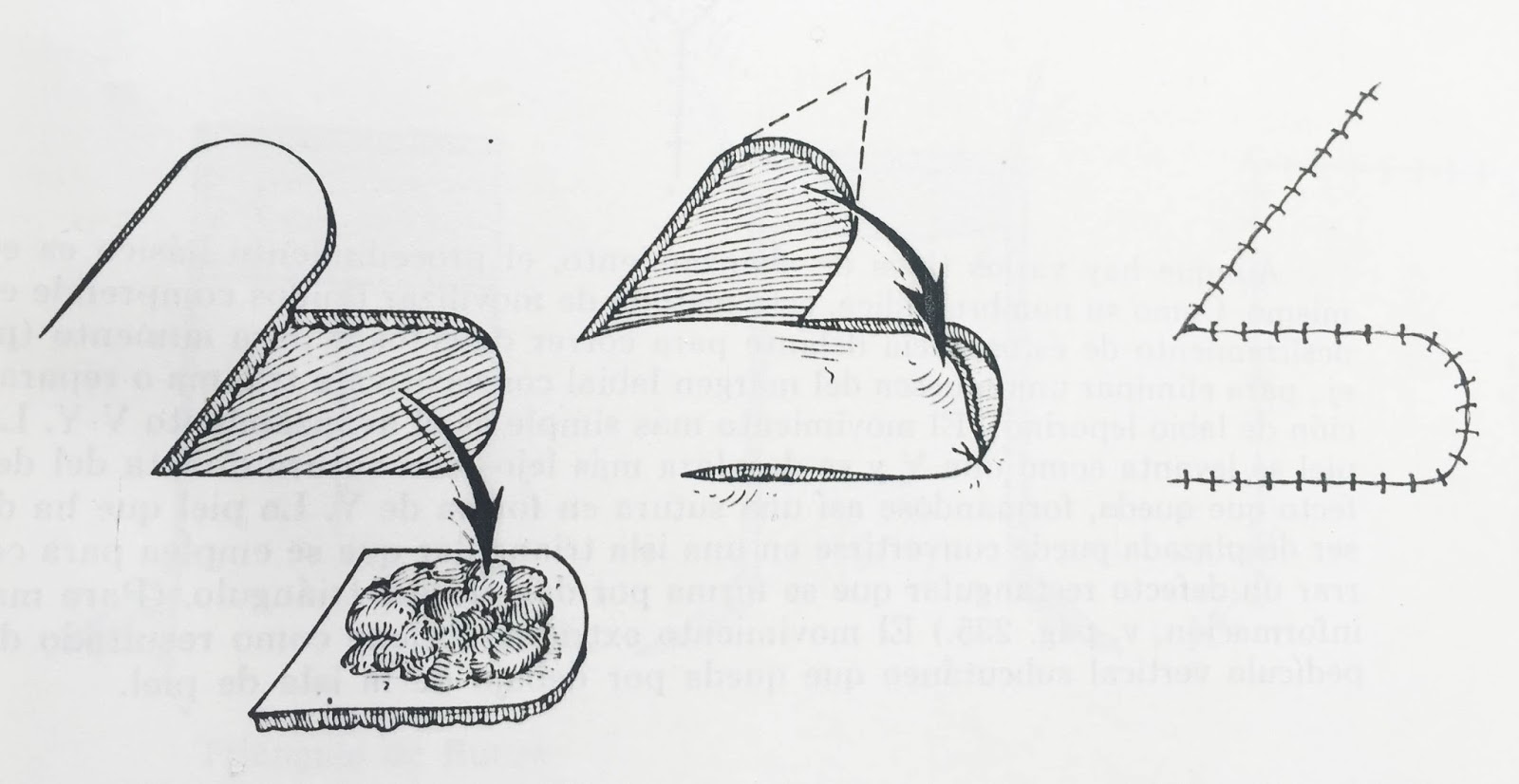 Curso de Cirugía Plástica CiruplasMedia: Colgajos