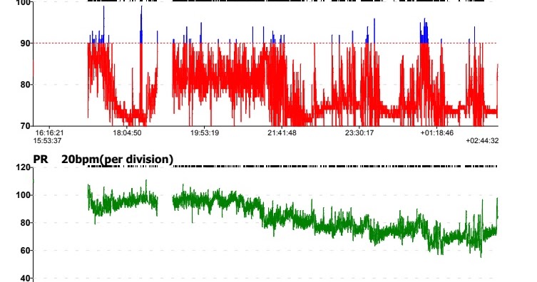 Sleep apnea : SPO2 @ 12000 feet elevation