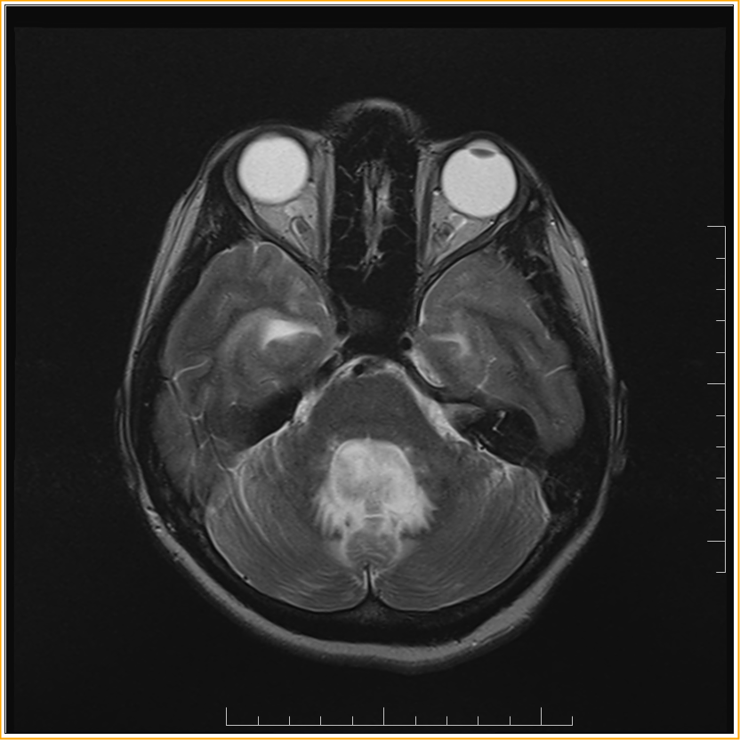 Obstruction of Magendie's Foramen :MRI - Sumer's Radiology Blog