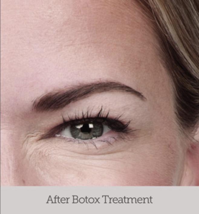 5 Reasons To Start Botox in Your 30s - The Skin Radar