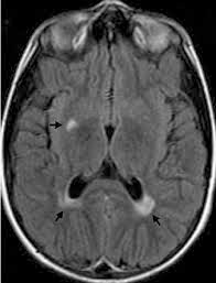 Medical Treatment Pictures-for Better Understanding: MELAS Syndrome