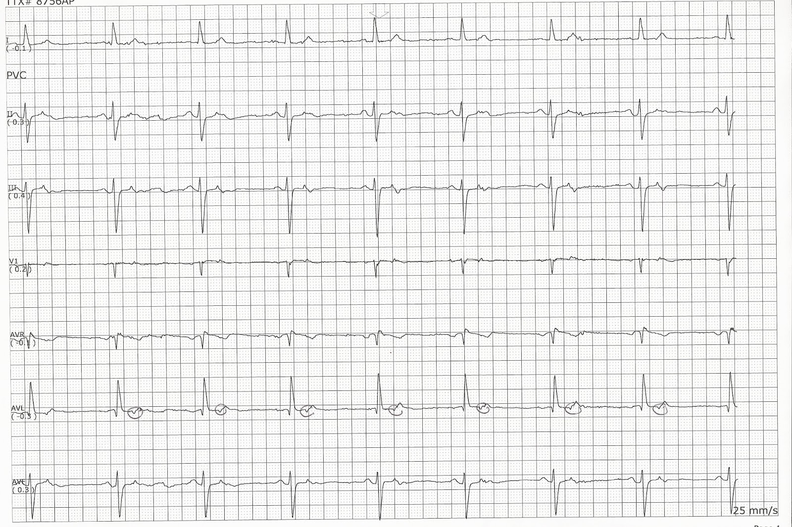 Bigeminal dropped PACs