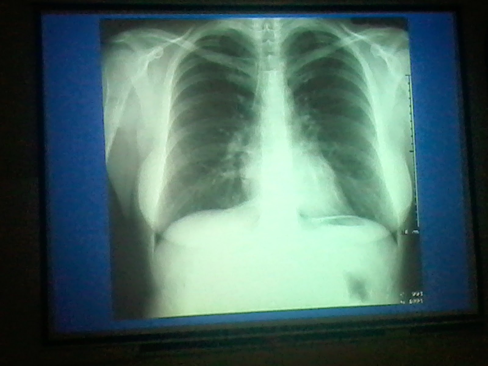 Lecture slides: Radiology: chest X ray