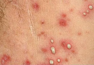 Nurul aida wahidah: penyakit kelainan pada kulit