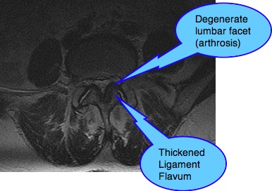 What Causes Facet Joint Hypertrophy With Cyst