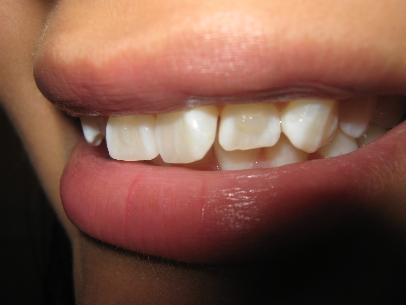 Br@ndy's Invisalign Journey: Tray 10