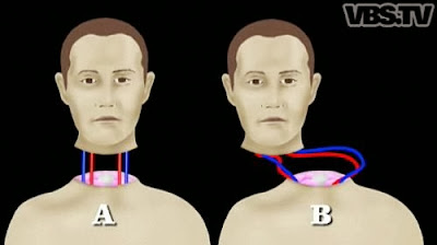 Operasi Transplantasi Sambung Kepala Manusia Bisa Dilakukan ...