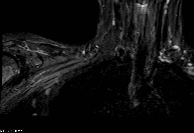 Brachial Plexitis -MRI - Sumer's Radiology Blog