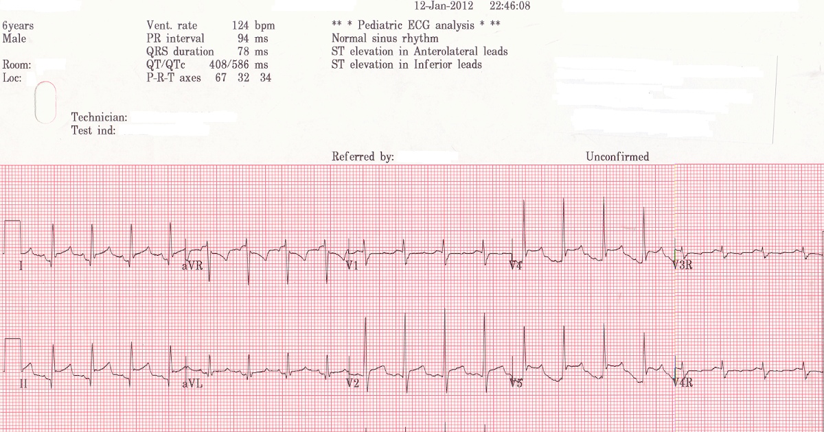 Pedi cardiology: EKG: Postop. pericarditis