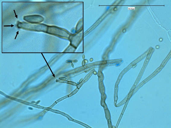 Fun With Microbiology (What's Buggin' You?): Fonsecaea pedrosoi/monophora