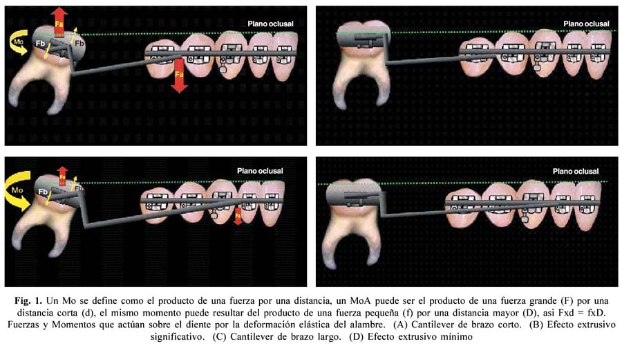 Física Dental Aplicada: La física de los brackets