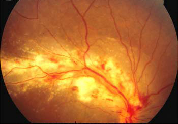 Citomegalovirus - Mononucleosis Infecciosa ~ MEDICINA CLÍNICA Y QUIRÚRGICA