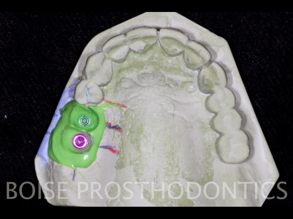 Boise Idaho Prosthodontics: Posterior Provisional Zimmer Implant ...