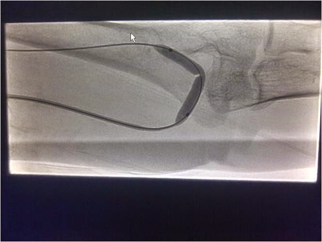 Spesialis Bedah Vaskular dan Endovaskular: Prosedur : Cimino, AV ...