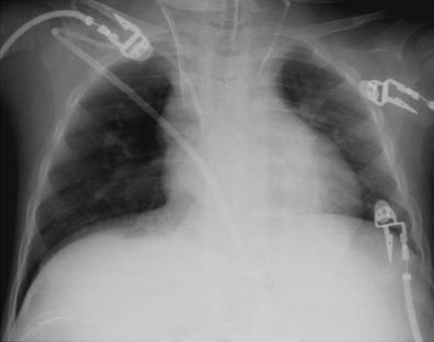 Tecnicos Radiologos: Signo del surco profundo en Neumotórax