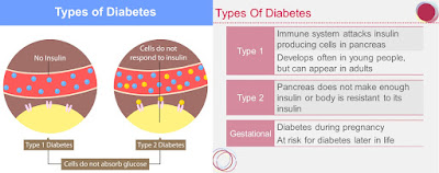 Definition and Types of Diabetes Mellitus