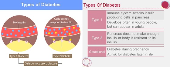 The Different Types of Diabetes Mellitus