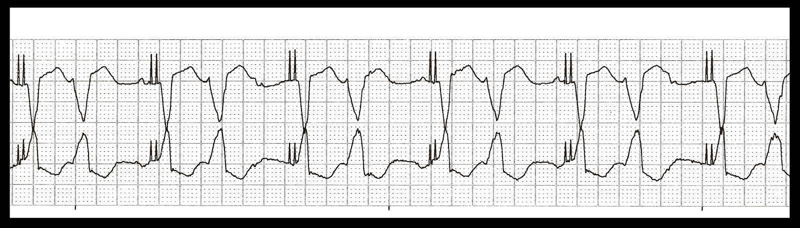 Float Nurse: Various Biventricular Paced Rhythms