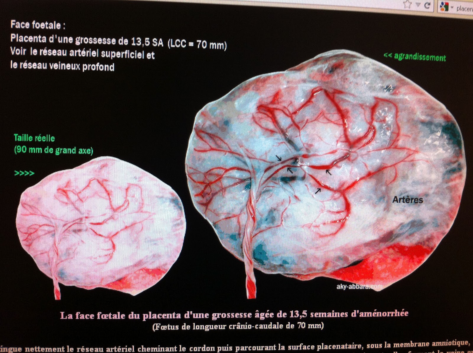 PROYECTO MATRONAS: 32. VA DE PLACENTAS