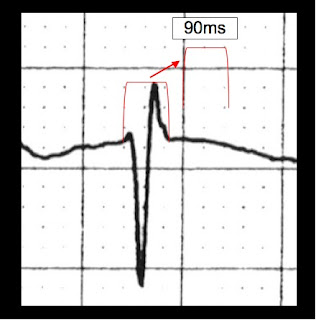 Cardiac Nurse: Teaching As I Learn: Defining Incomplete Right Bundle ...