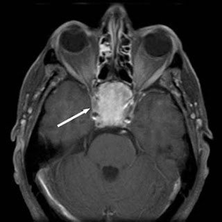 What Is Chordoma - With Health