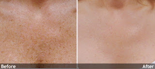 Pratha Atluri MD: Decollete Rejuvenation