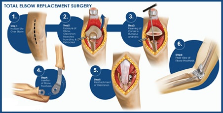 Medical Tourism in India | Medi Mantra Healthcare: Total Elbow Replacement Surgery