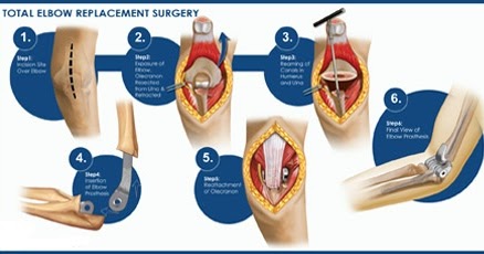 Medical Tourism in India | Medi Mantra Healthcare: Total Elbow ...