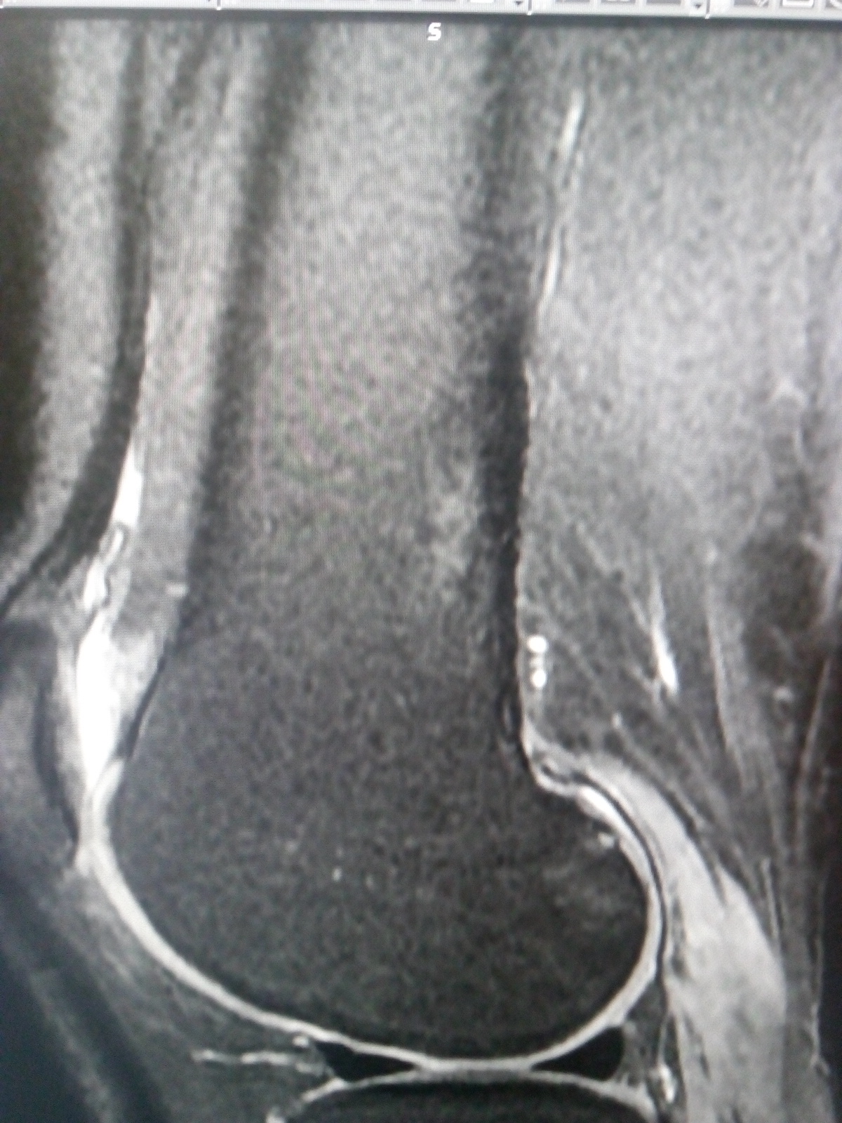 Neurogenic tumor: Teaching Points - Sumer's Radiology Blog