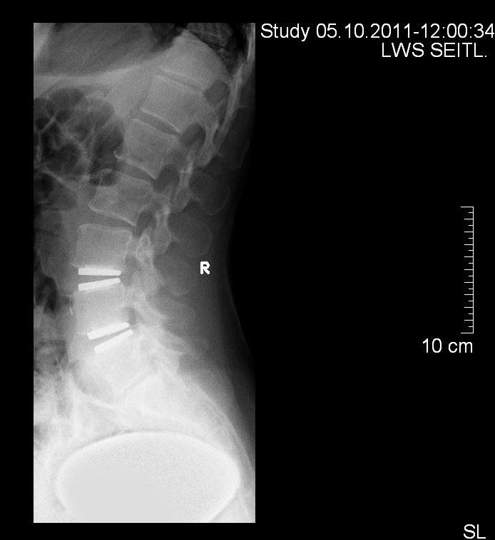 MySpineSolution: Best Hospital for M6 Disk Replacement