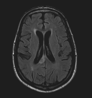 Corpus Callosum Infarction-MRI - Sumer's Radiology Blog