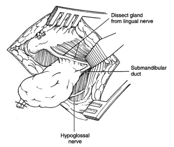 Dental Care: Submandibular Gland Resection