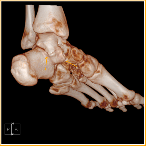 Subtalar talocalcaneal coalition-CT - Sumer's Radiology Blog