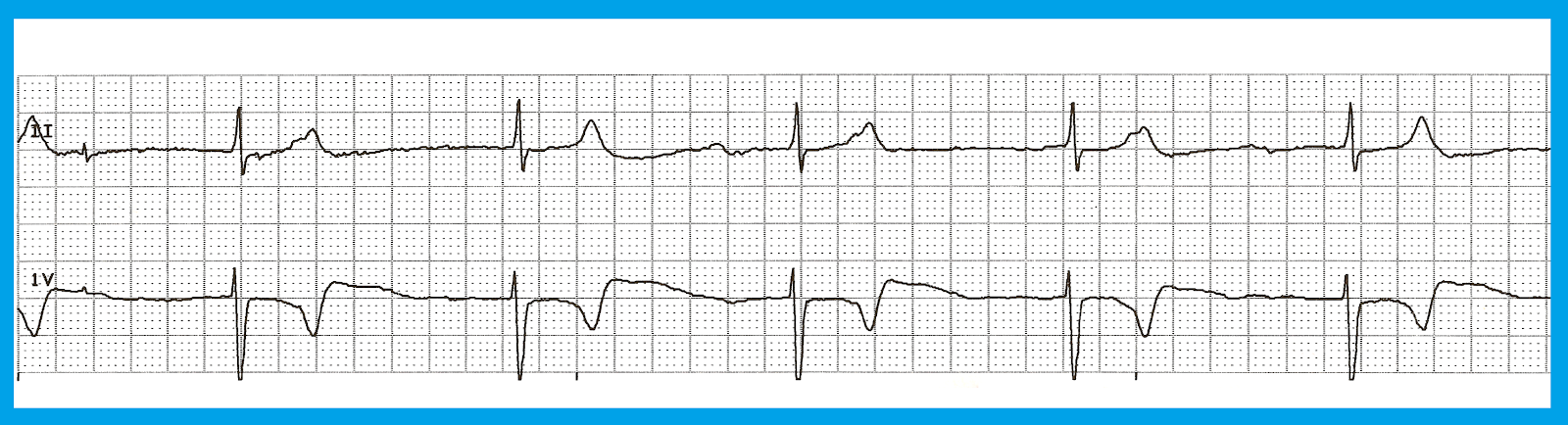 Practice EKG Strips 319