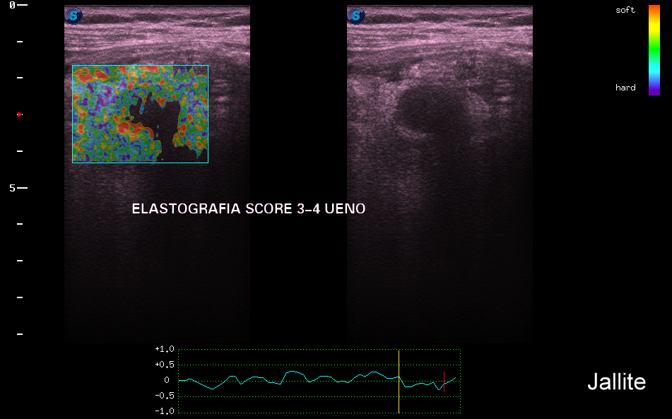 Plastron Apendicular