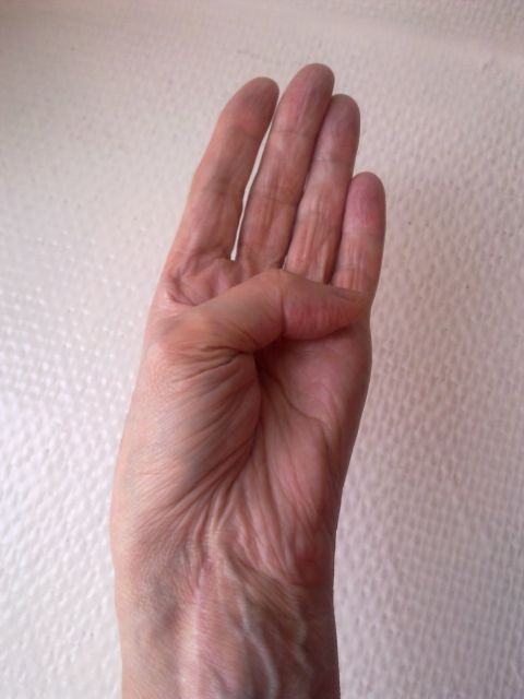 Handrehabilitationcase with Dupuytren's contracture.: A trauma in the ...