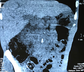 VIETNAMESE MEDIC ULTRASOUND: CASE 491: TOOTHPICK MOVING TO ...