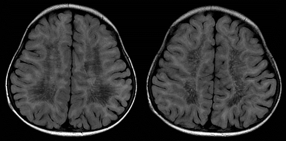 Radshare: METACHROMATIC LEUKODYSTROPHY