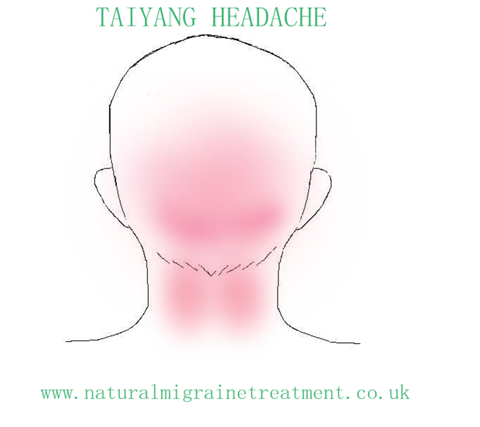 Natural Migraine Treatment: The 6 different types of Migraine related ...