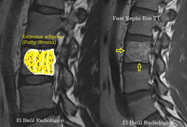 Hemangioma Spine Mri T1 T2 Wrocawski Informator Internetowy Wrocaw Wroclaw Hotele Wroc