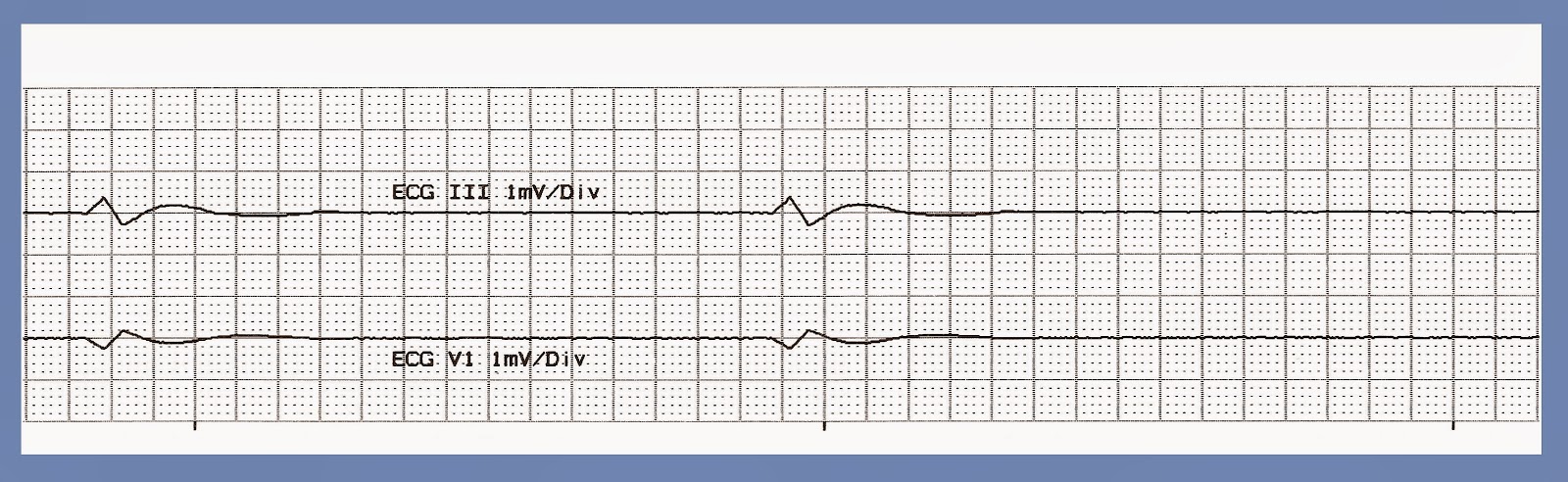 Basic EKG Rhythm Test 24