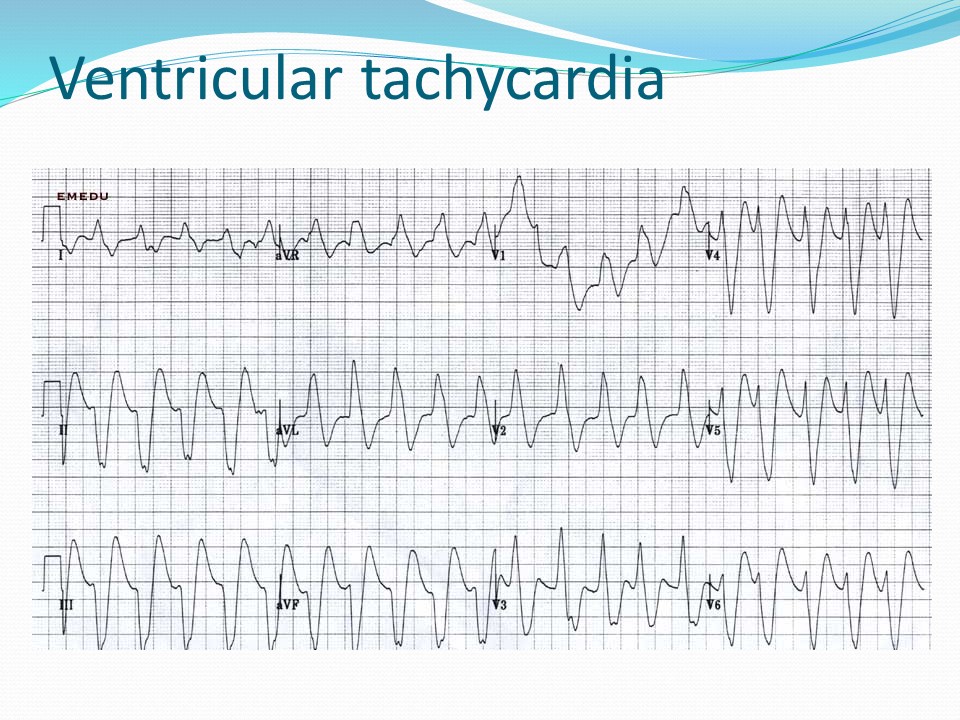 CVT Mohd Farid: Electrocardiogram ECG Part II Common Abnormalities Part II