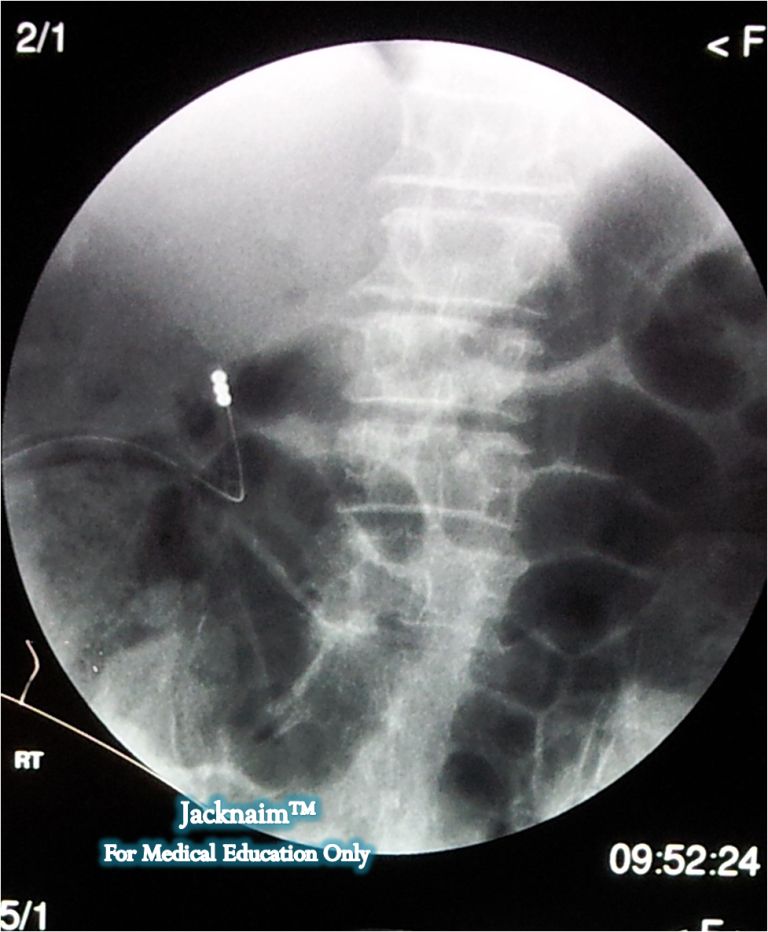 Cholangiogram