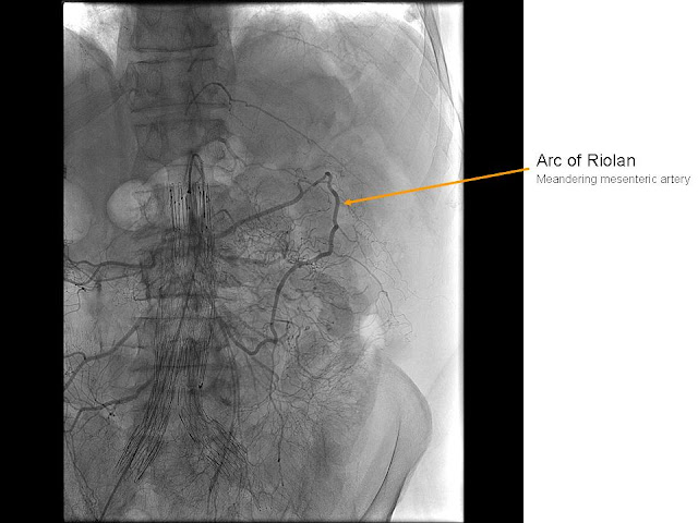 The Pump and the Tubes: Arc of Riolan / "meandering mesenteric artery"