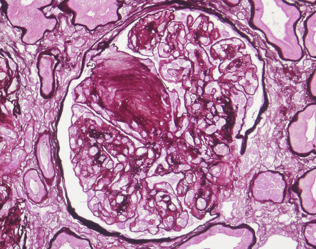 Renal Pathology Review: Idiopathic nodular glomerulosclerosis