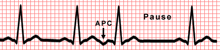 Premature Atrial Contraction / Atrial Ekstrasistol | INA - ECG