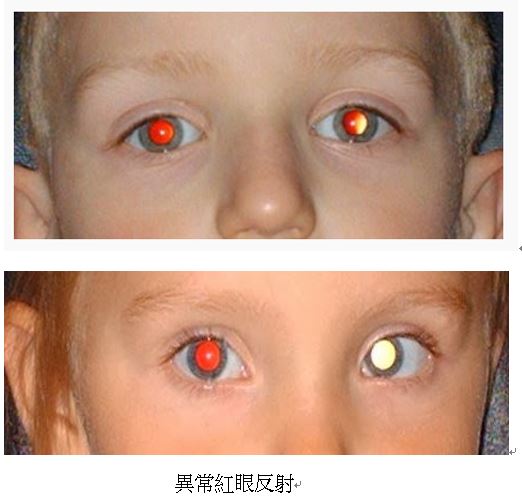 進達眼鏡-視光新知分享: 紅眼現象與Bruckner Test布魯克納測試篩檢臨床觀察